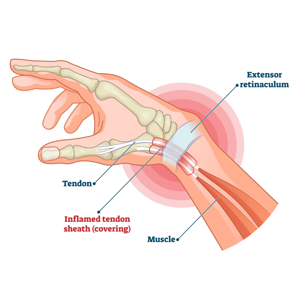 Sprained Wrist Bruising Wrist Sprain Symptoms, Treatment In Dallas,